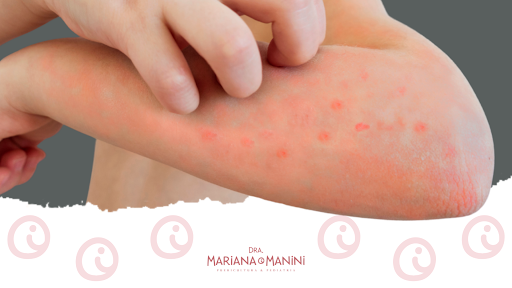 Catapora | Blog | Dra Mariana Manini - Pediatra