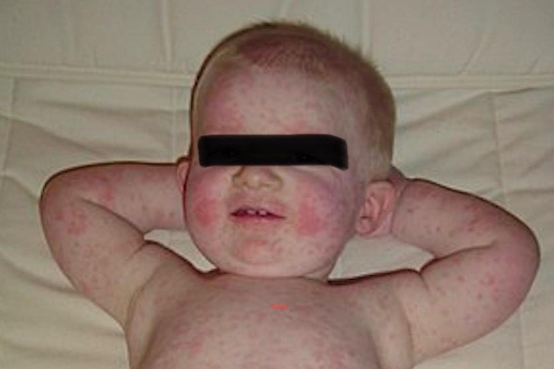 Eritema Infeccioso: O Que os Pais Precisam Saber - Dra. Mariana Manini